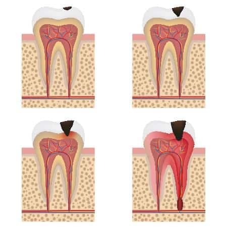 Root Canal Bundaberg Dentist | Bargara Dentist
